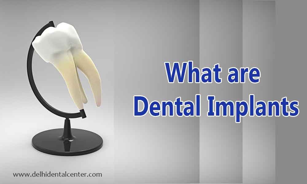 What are Dental Implants?