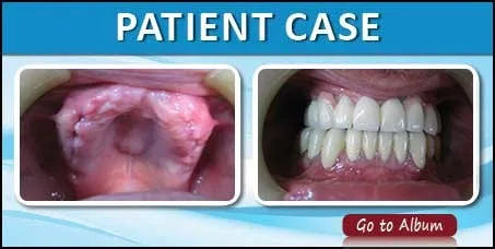 Patient Cases - Full Mouth Dental Implants India