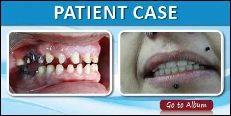 Patient Cases - Full Mouth Dental Implants India