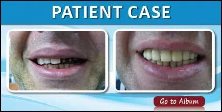 Patient Cases - Full Mouth Dental Implants India