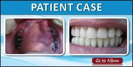 Patient Cases - Full Mouth Dental Implants India